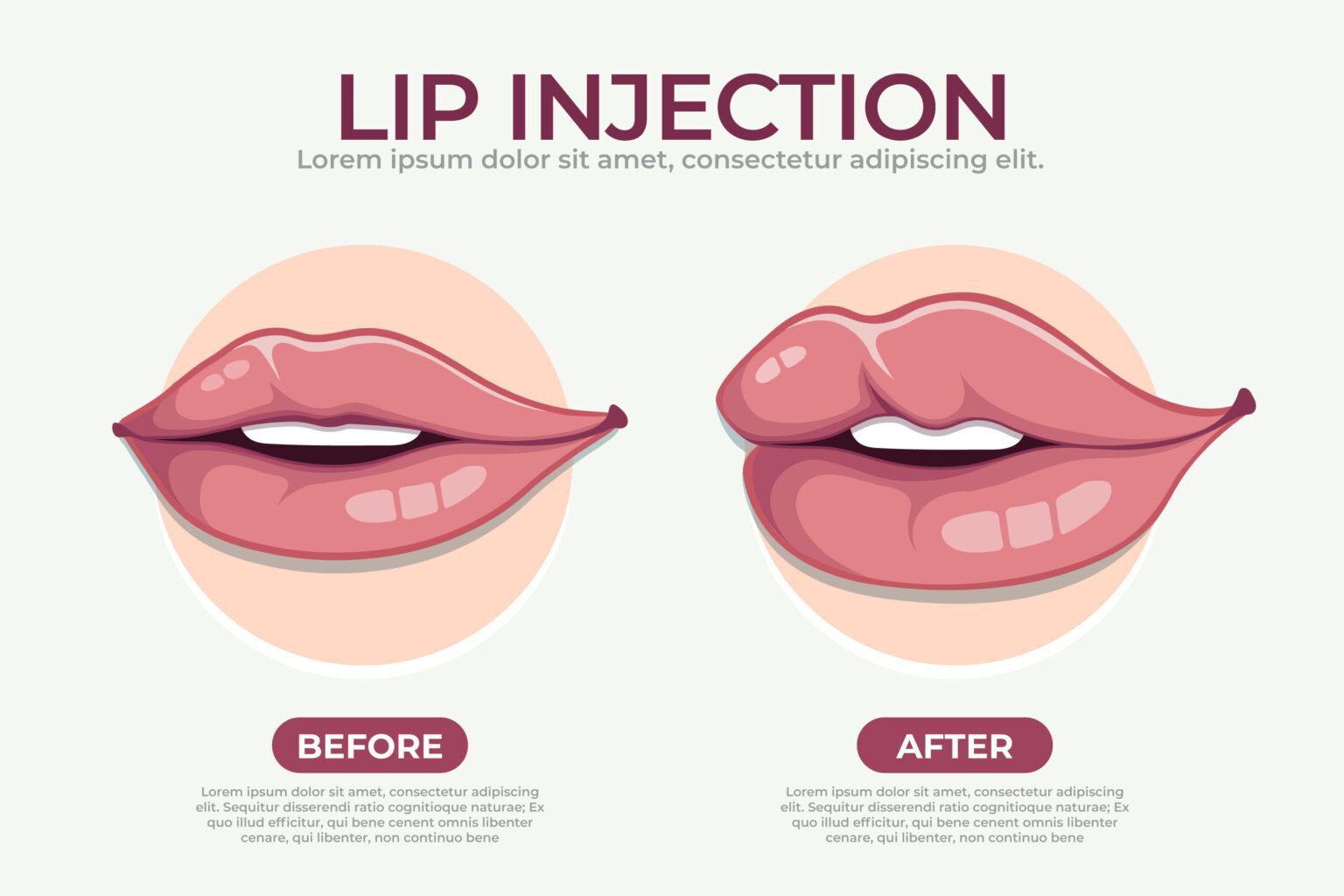 Lip Botox Before and After: Stunning Results, Lip Flip Secrets & Expert ...
